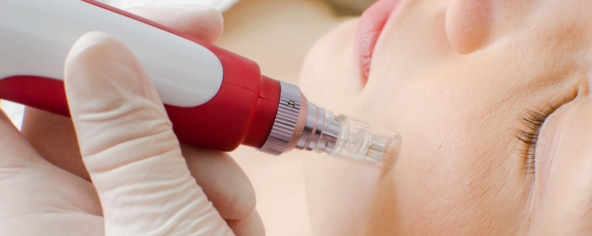 Micro-Needling - Praxis Dresden | Heilpraktikerin Katrin Geißler